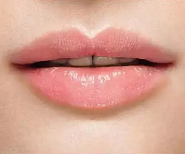 ¿Cuáles Son Las Formas De Labios De Relleno Más Comunes? | IAMT