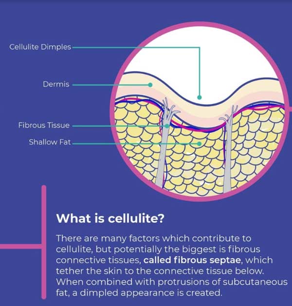 Di Adiós A La Celulitis: Una Solución Innovadora | IAMT