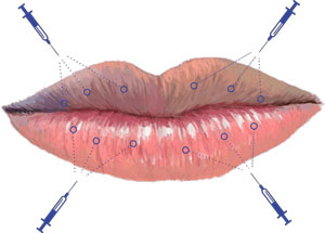 Cursos Avanzado De Rellenos De Labios | IAMT